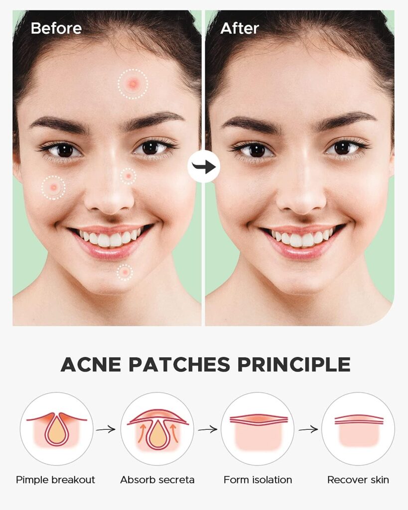 ZATKTK Acne Pimple Patch Review – hydrocolloid pimple patches